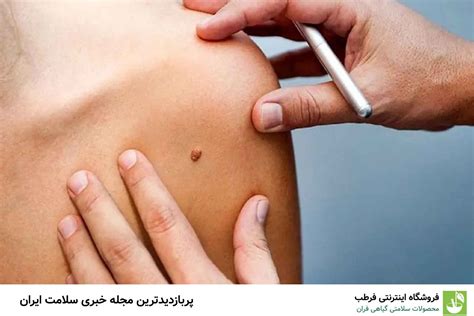 برداشن این خال ها خطرناک است به خال هایتان دست نزنید