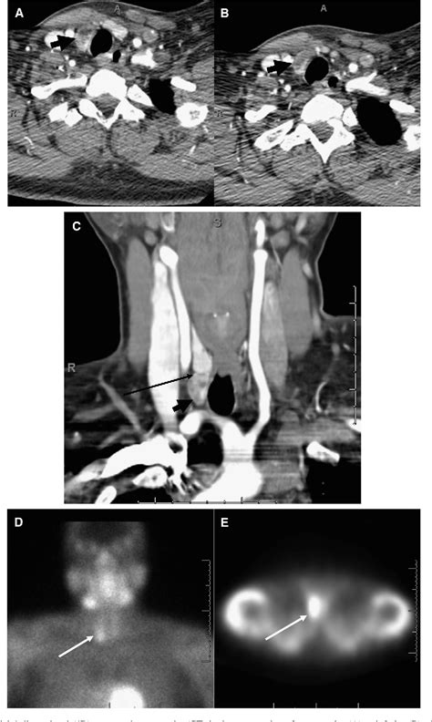 Figure 2 From Preoperative Localization Of Parathyroid Adenomas Using 4 Dimensional Computed