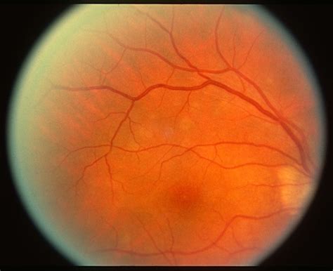 Color Fundus Photo Showing Multifocal Choroiditis Retina Image Bank