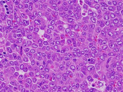 Myeloid Sarcoma