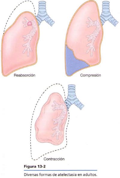 Medicina Unlp PatologÍas Respiratorias I AnomalÍas CongÉnitas Edema