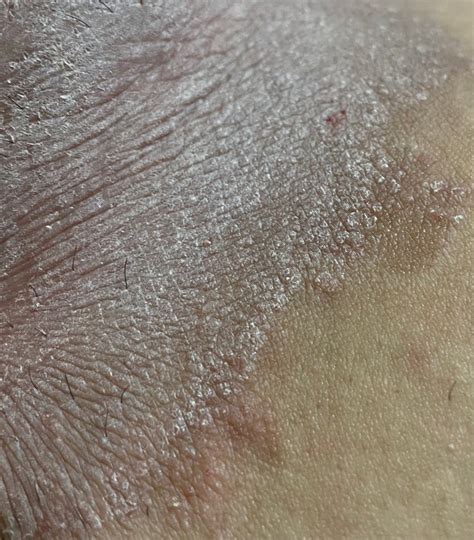 사타구니 습진 지식in