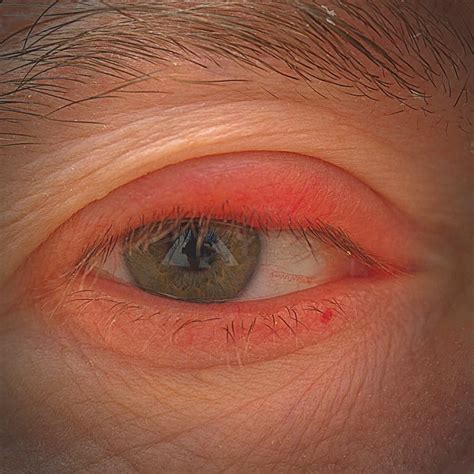 Preseptal Cellulitis Eyefacts