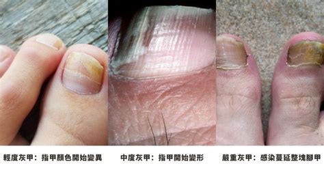 拆解灰甲初期特徵｜灰指甲治療方法知多啲｜靚靚指甲重見天日