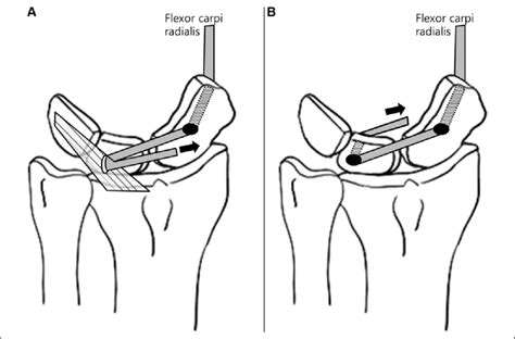 Methods Of Scapholunate Interosseous Ligament Slil Reconstruction Download Scientific