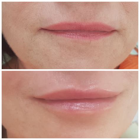 Поставяне на филъри за устни и бръчки Дермални филъри за устни