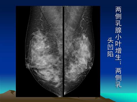 乳腺癌的钼靶诊断word文档在线阅读与下载无忧文档