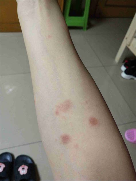 湿疹痒不痒梅毒痒不痒 伤感说说吧