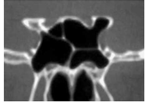 Coronal Ct Shows Multiple Sphenoid Septation With Extension Of The