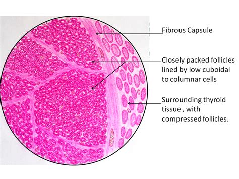Follicular Adenoma Thyroid Pathology Made Simple