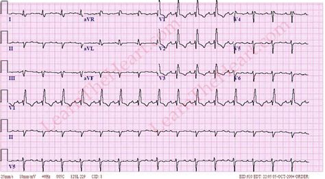 Bifascicular Block Lafb Rbbb Ecg 2