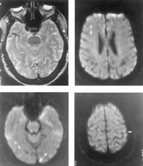 Figure 2 From Imaging Transient Ischaemic Attacks Tias Are We