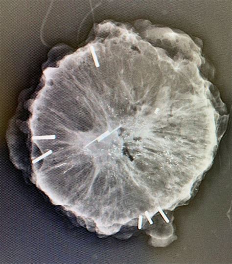 Savi Scout Radiation Free Localisation Technology For Breast Cancer Professor Kefah Mokbel