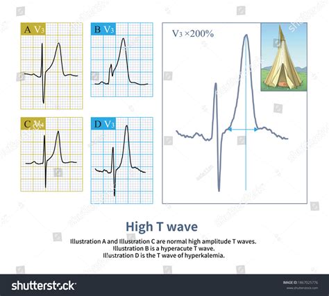 Hyperkalemia Over 45 Royalty Free Licensable Stock Illustrations