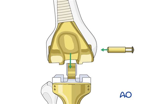 Proximal Tibia Replacement For Fracture Around A Loose Tibial Component