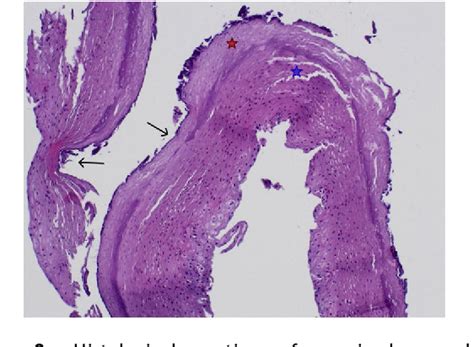 Figure 2 From Esophageal Desquamation In Pediatrics Esophagitis