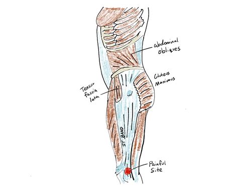 Iliotibial Band Trigger Points
