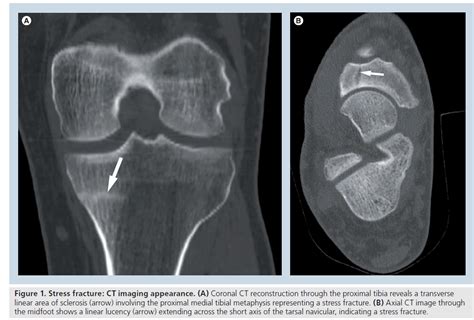 Linear Fracture X Ray
