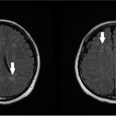 Pdf Hyperammonemia In A Pregnant Woman With Citrullinemia Type I A Case Report And Literature