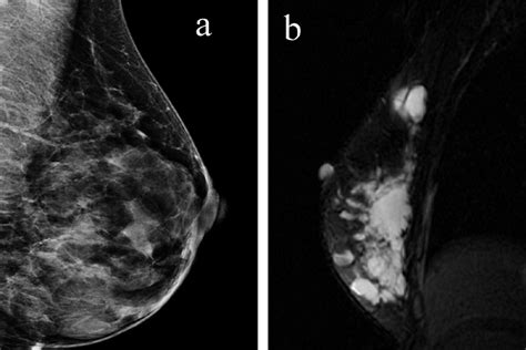Mammogram Showing Cyst Mammogram Showing Cyst