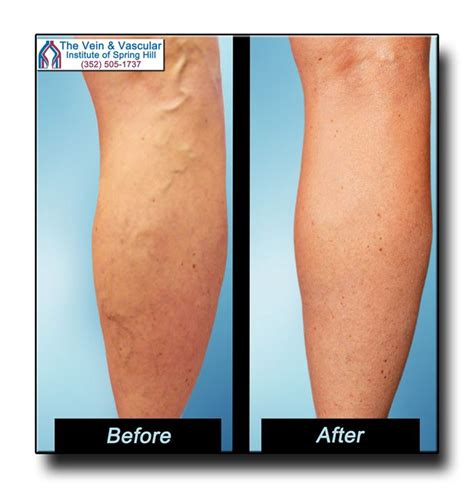 Varicose Veins Before And After Pictures Vein And Vascular Institute Artofit