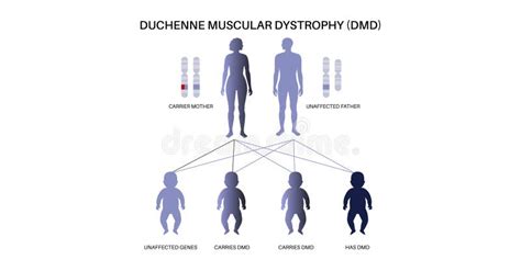 Duchenne Muscular Dystrophy Stock Vector Illustration Of Offspring Human 319619214