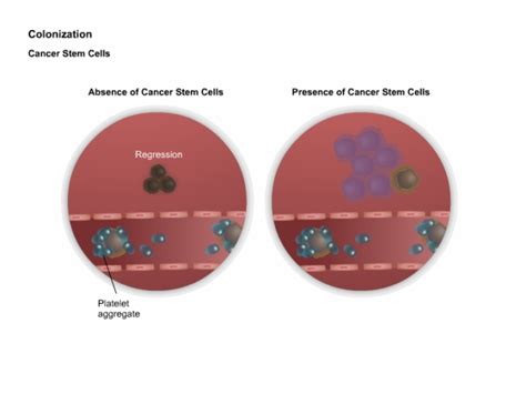 Oncology Primer Invasion And Metastasis