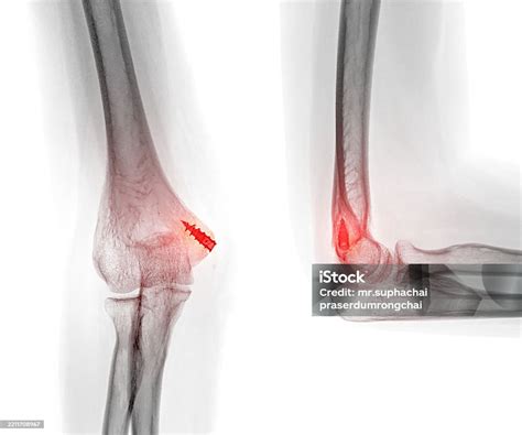 고정 나사가 제자리에 있는 수술 후 팔꿈치 관절을 보여주는 Xray는 골절 부위와 염증을 빨간색으로 강조합니다 X 레이에 대한