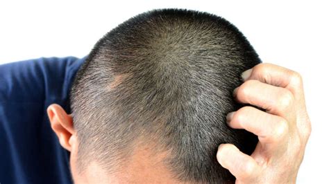 Scalp Atopic Dermatitis Other Skin Conditions 52 Off