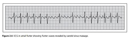 Atrial Flutter Atrial Arrhythmias