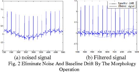 Figure 2 From A Simple Algorithm For Detection Of Qrs Onset And Offset