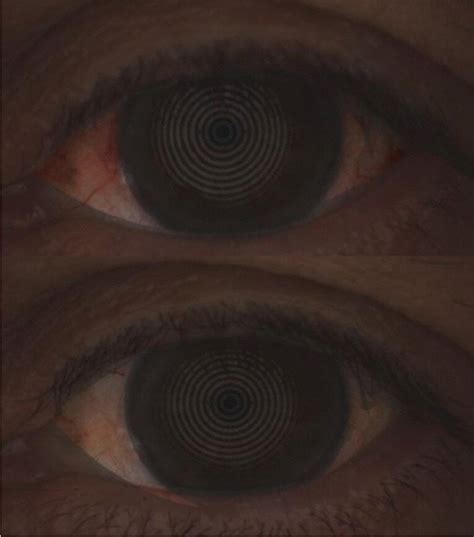 Images Taken From The Keratograph Show The Conjunctival Redness Before