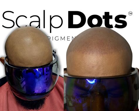 Scalp Dots Hair Loss Treatment India Scalp Micropigmentation Clinics