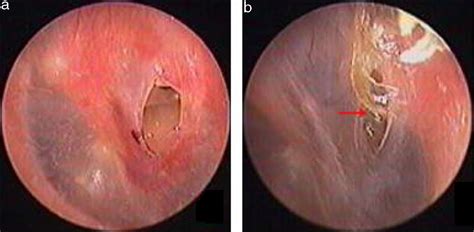 Healed Perforated Tympanic Membrane Ruptured Eardrum Hole In Eardrum