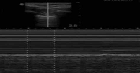 Pocus Made Easy Lung • Litfl • Ultrasound Library