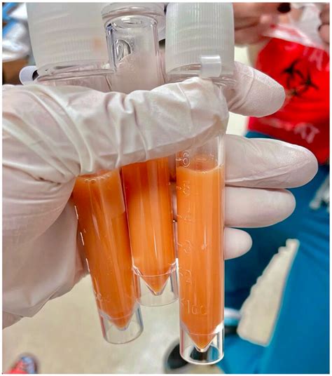 Paracentesis Fluid Color