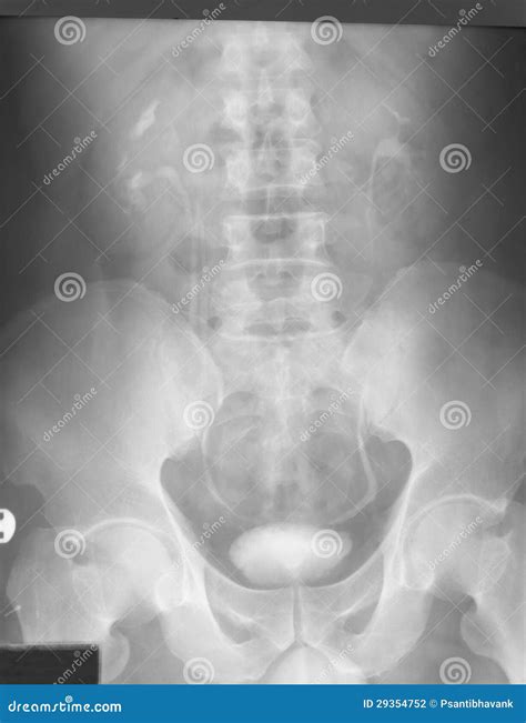 Intravenous Pyelography Ivp 10 Minutes After Urographin Injection Film Of A 41 Years Old Man