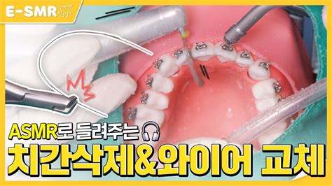 치과 전용 백색소음 치간삭제and와이어교체 Asmr🌃 Youtube