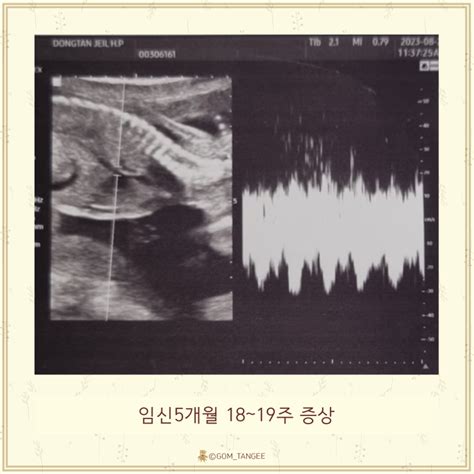 임신5개월 임신중기 동탄제일병원18~19주 임산부 자궁경부길이 아랫배통증과 밑빠짐 증상 네이버 블로그