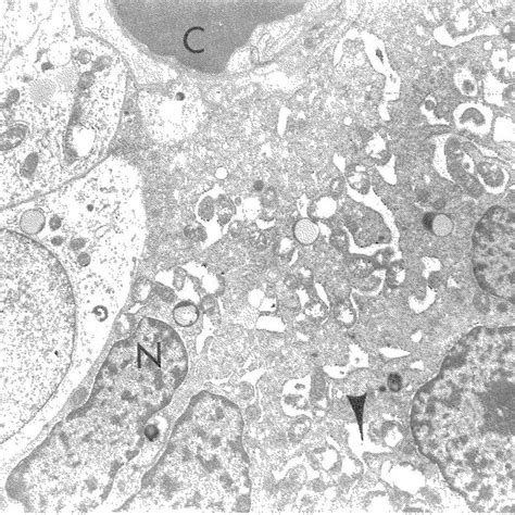 Parathyroid Cyst Arrow Derived From The Persistence And Distention