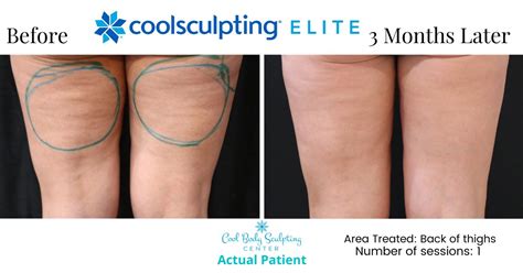 We Did Some Experimenting With Coolsculpting And Found Our Flat