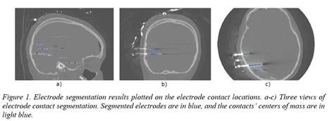 Automated Visualization Of Ictal And Interictal Seeg Activity To Improve Surgical Planning In