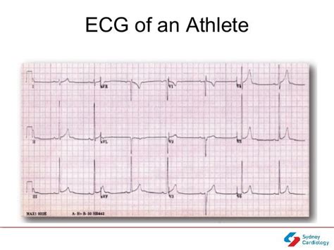 Athletes Heart