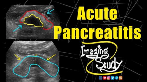 Acute Pancreatitis Ultrasound Ct Case 206 Youtube