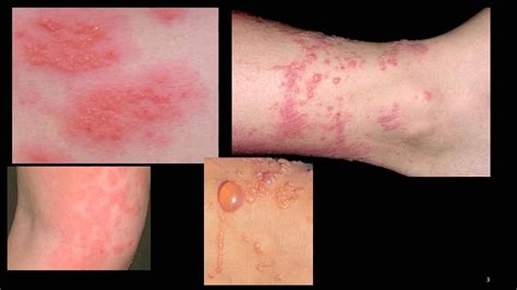 Contact Dermatitis Youtube