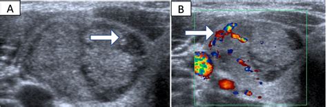 Thyroid Ultrasound For Patient 6 A 20 Year Old Female Who Presented Download Scientific