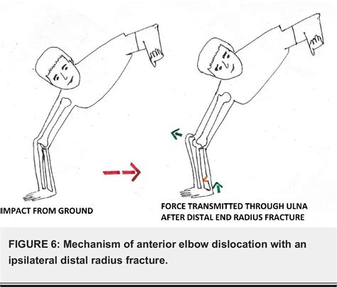 Figure 6 From A Rare Combination Of Complex Elbow Dislocation And