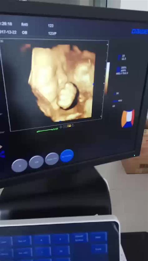 Medical 3d Color Usg And Full Digital 4d Ultrasound For Pregnancy Buy Sonosite Micromaxx