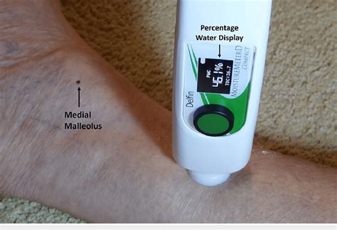 Tdc Measurement Example On The Lower Extremity A Compact Version Is