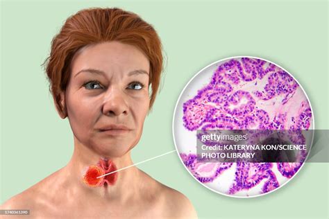 Woman With Thyroid Cancer Illustration High Res Vector Graphic Getty